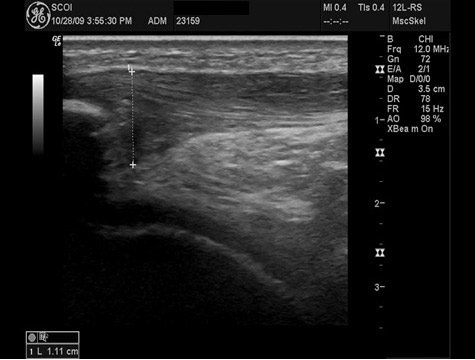Platelet Rich Plasma (PRP) Treatment And Its Use In Patellar Tendinopathy